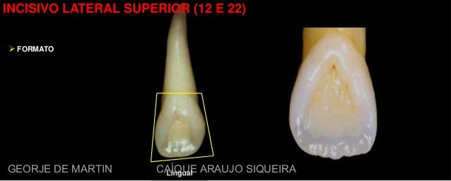 Anatomia dental protec incisivos superiores - georje de martin 2013