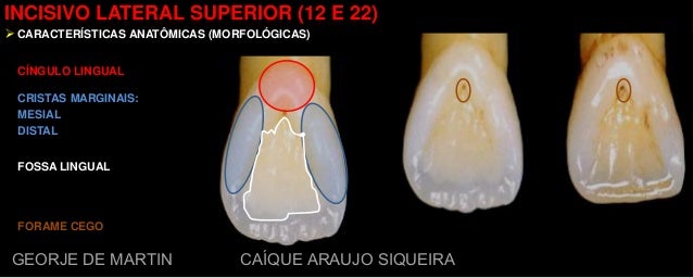 Anatomia dental protec incisivos superiores - georje de martin 2013