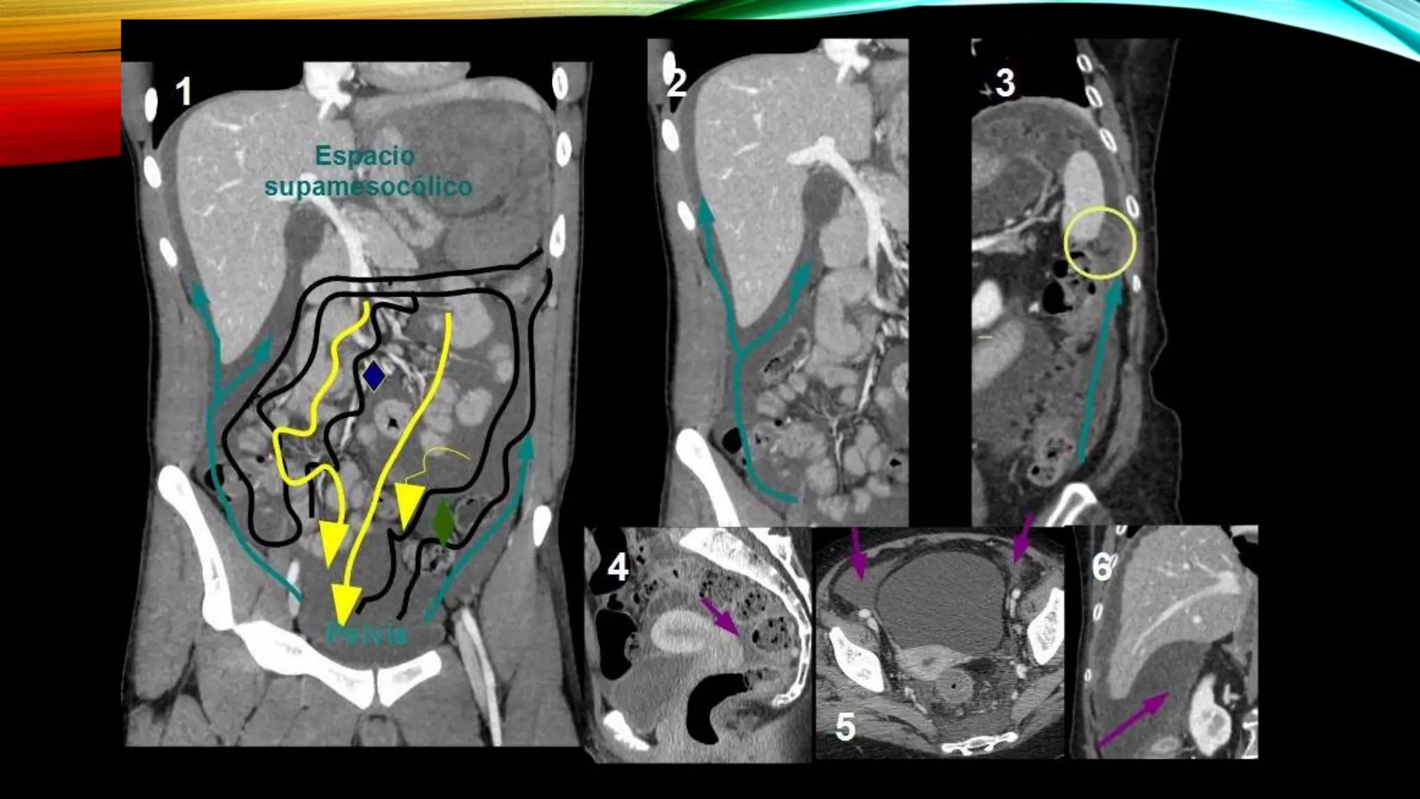 Anatomia de peritoneo | PPTX