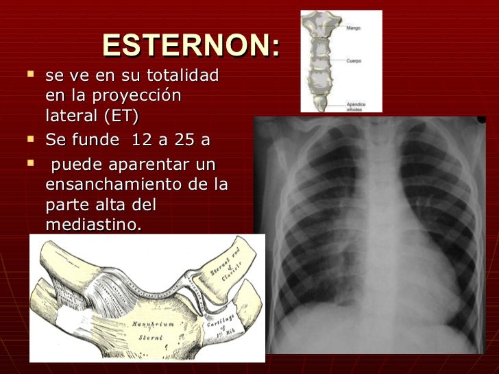 Definición y significado de esternón: esternón anatomia – FIOGN