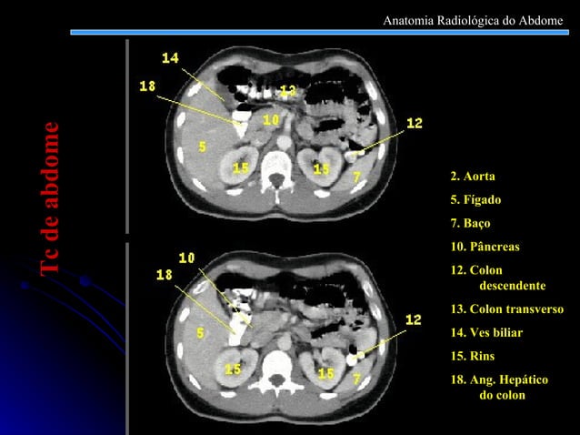 Anatomia do abdome por tc