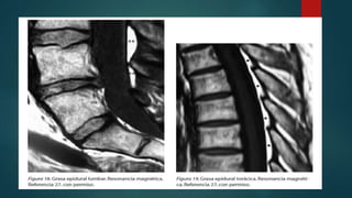 Anatomia espacio epidural | PPTX