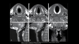 ANATOMIA RADIOLOGICA DE FARINGE Y LARINGE | PPTX