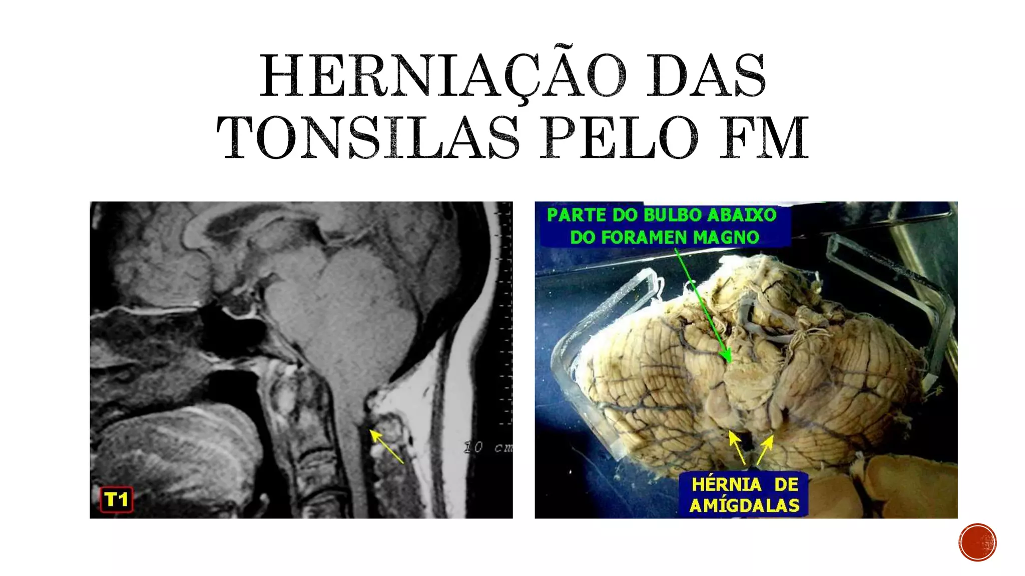 Anatomia do forame magno | PPTX