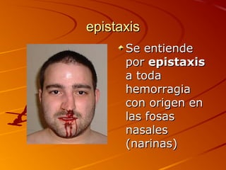 Anatomia nasal - epistaxis | PPT