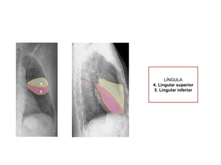 Anatomía de tórax normal, división radiológica de mediastino | PPTX