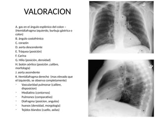 Anatomía de tórax normal, división radiológica de mediastino | PPTX