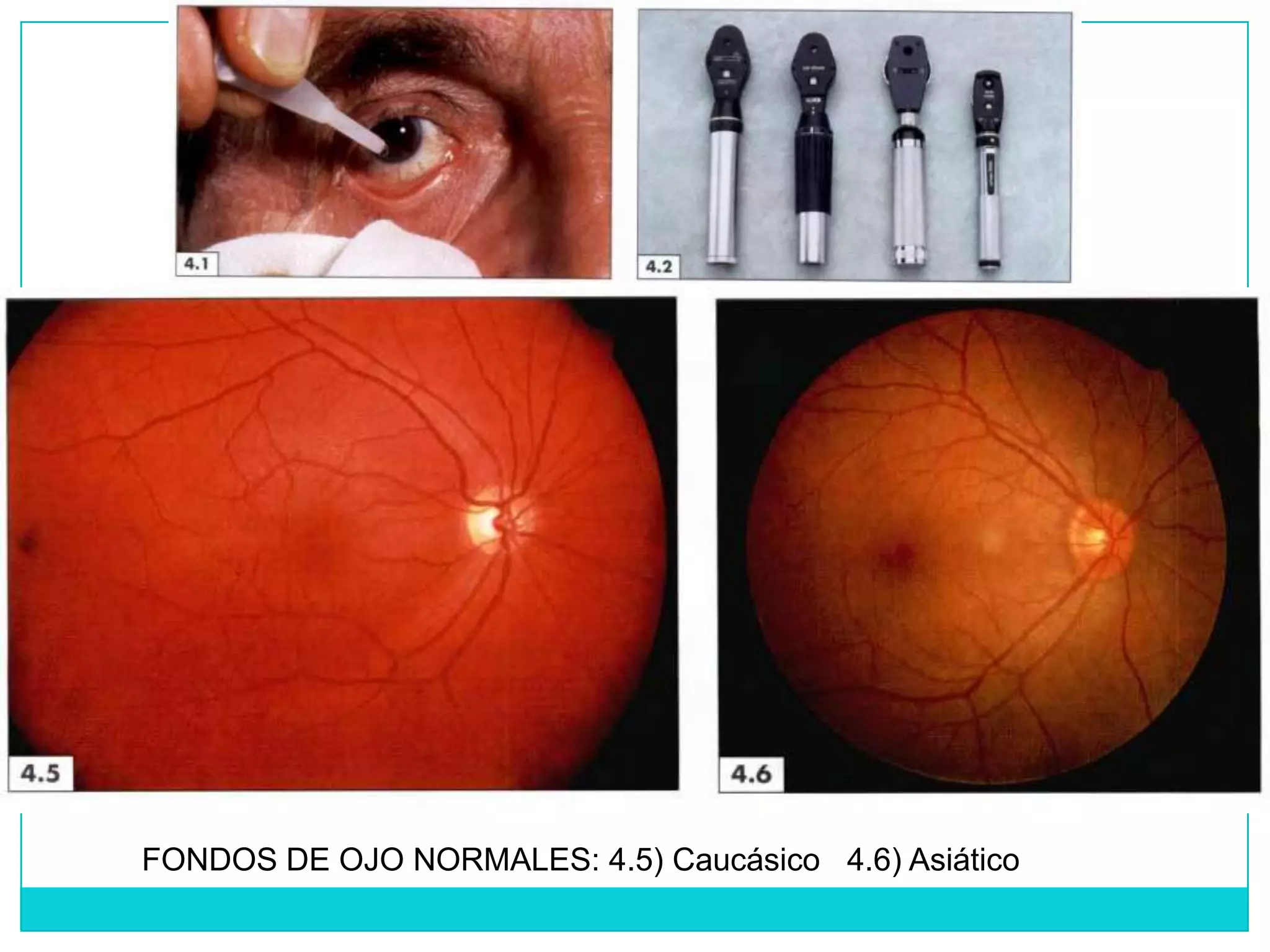 Anatomia Ojo, Cavidad Orbitaria y Anexos | PPTX