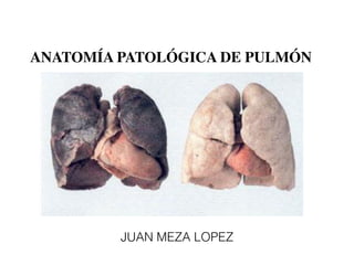 Anatomia patologica de pulmon | PDF