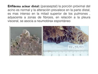 Anatomia patologica de pulmon | PDF
