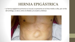 Anatomia quirurgica de la Hernia Epigastrica y Umbilical.pptx