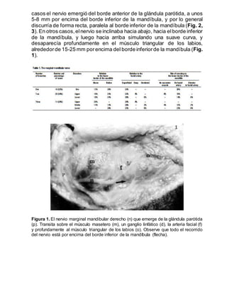 ANATOMIA QUIRURGICA DE LA RAMA MARGINAL MANDIBULAR DEL NERVIO FACIAL | DOCX