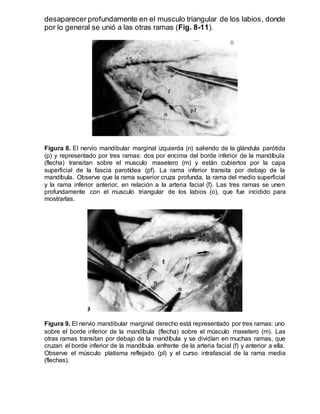 ANATOMIA QUIRURGICA DE LA RAMA MARGINAL MANDIBULAR DEL NERVIO FACIAL | DOCX