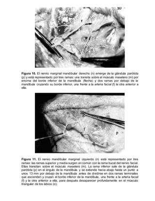 ANATOMIA QUIRURGICA DE LA RAMA MARGINAL MANDIBULAR DEL NERVIO FACIAL | DOCX