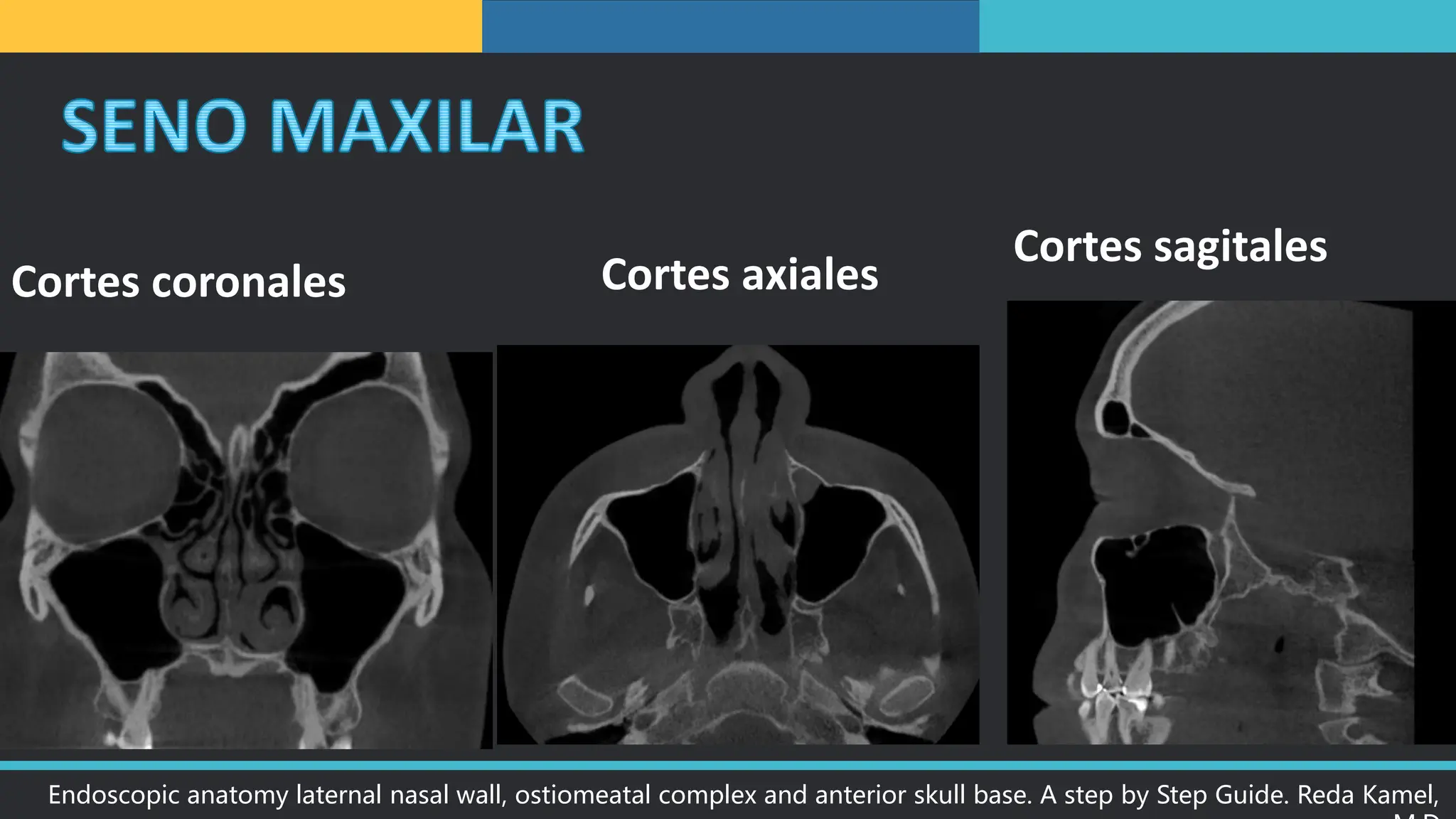 Anatomia quirurgica de Senos paranasales Lismary fellow 2.pptx