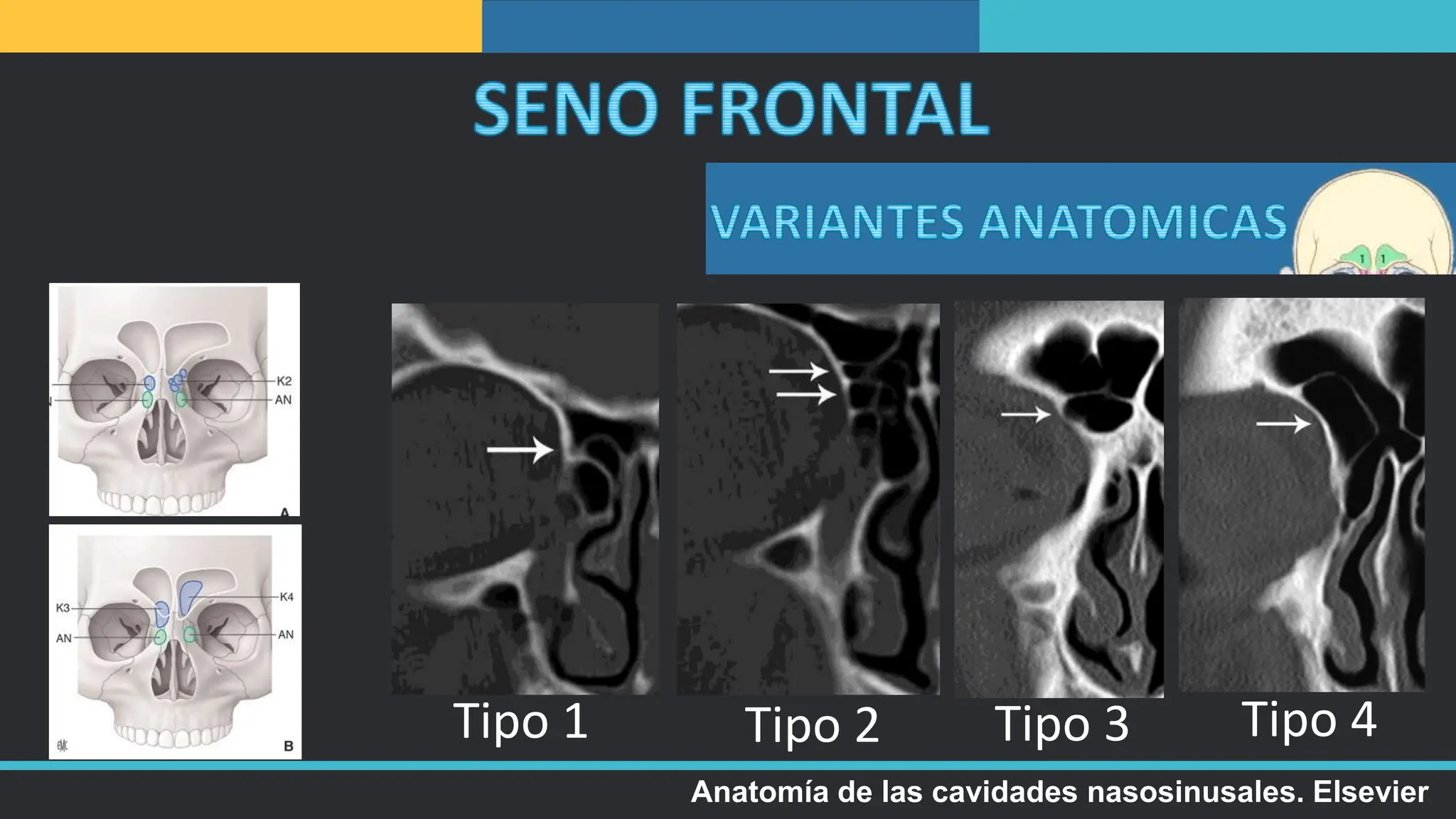 Anatomia quirurgica de Senos paranasales Lismary fellow 2.pptx