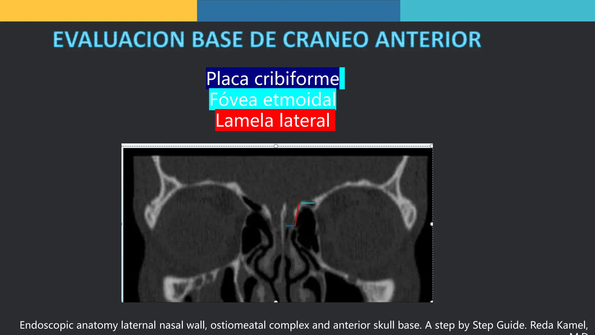 Anatomia quirurgica de Senos paranasales Lismary fellow 2.pptx