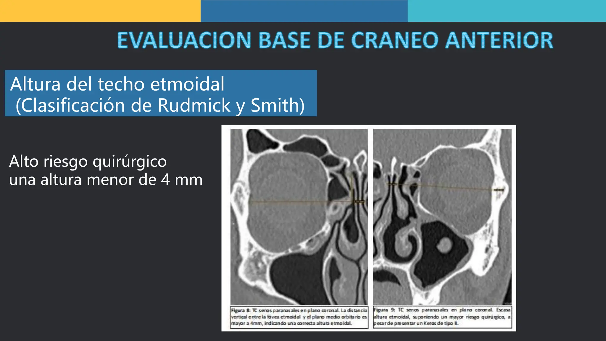 Anatomia quirurgica de Senos paranasales Lismary fellow 2.pptx
