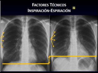 Anatomia radiografica torax | PPT