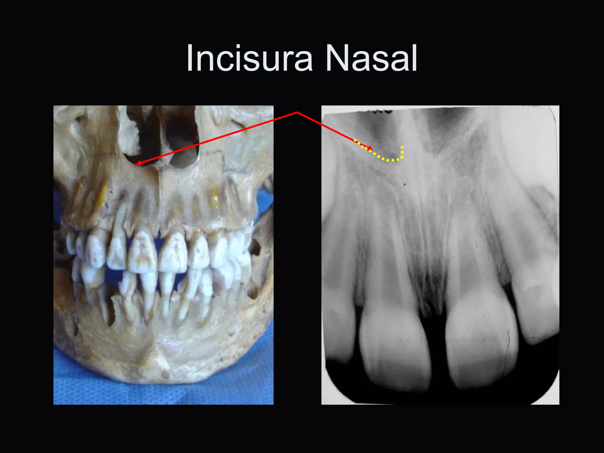 Anatomia radiográfica maxilar y mandíbula uss rx | PPT