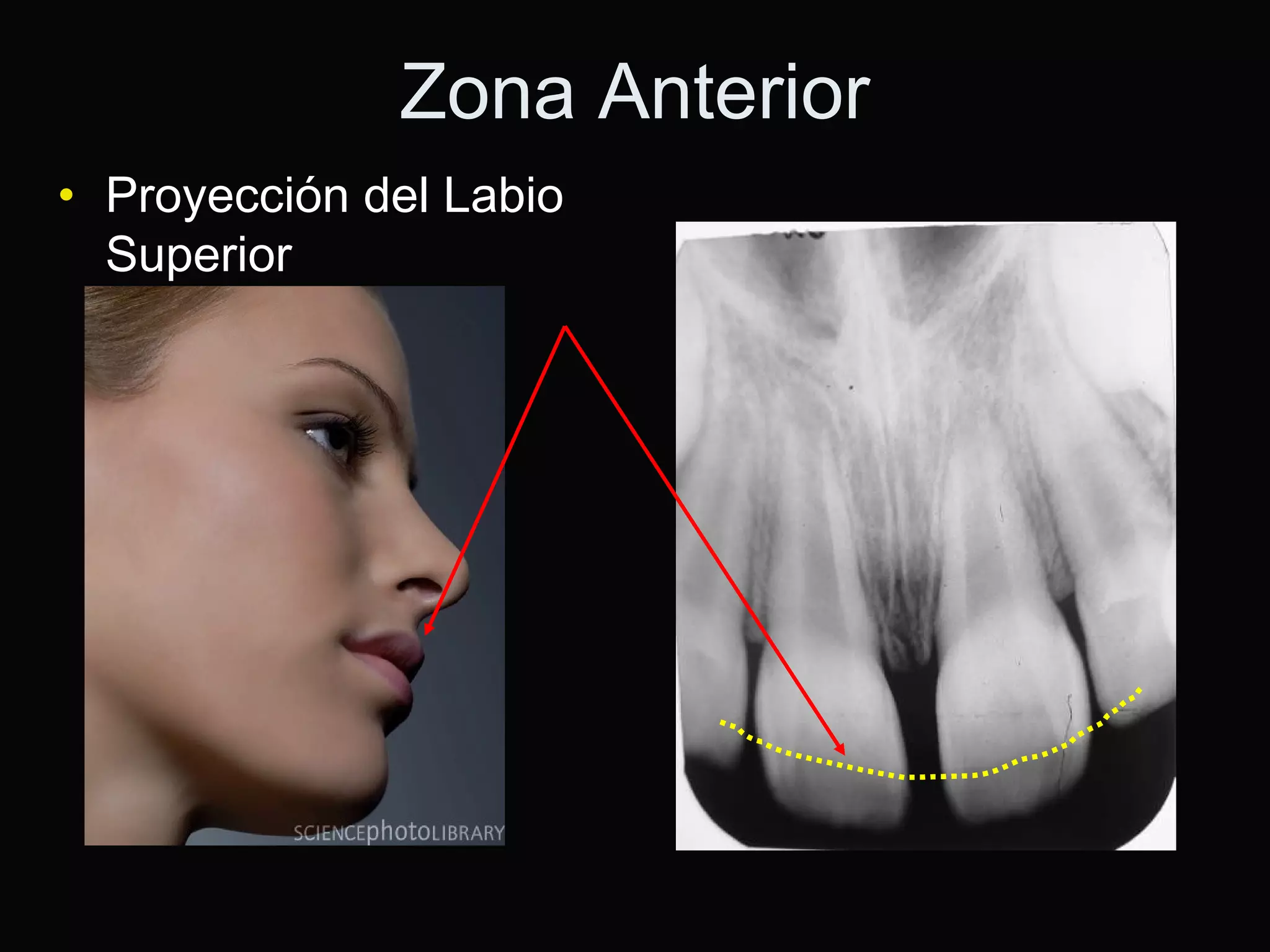 Anatomia radiográfica maxilar y mandíbula uss rx | PPT