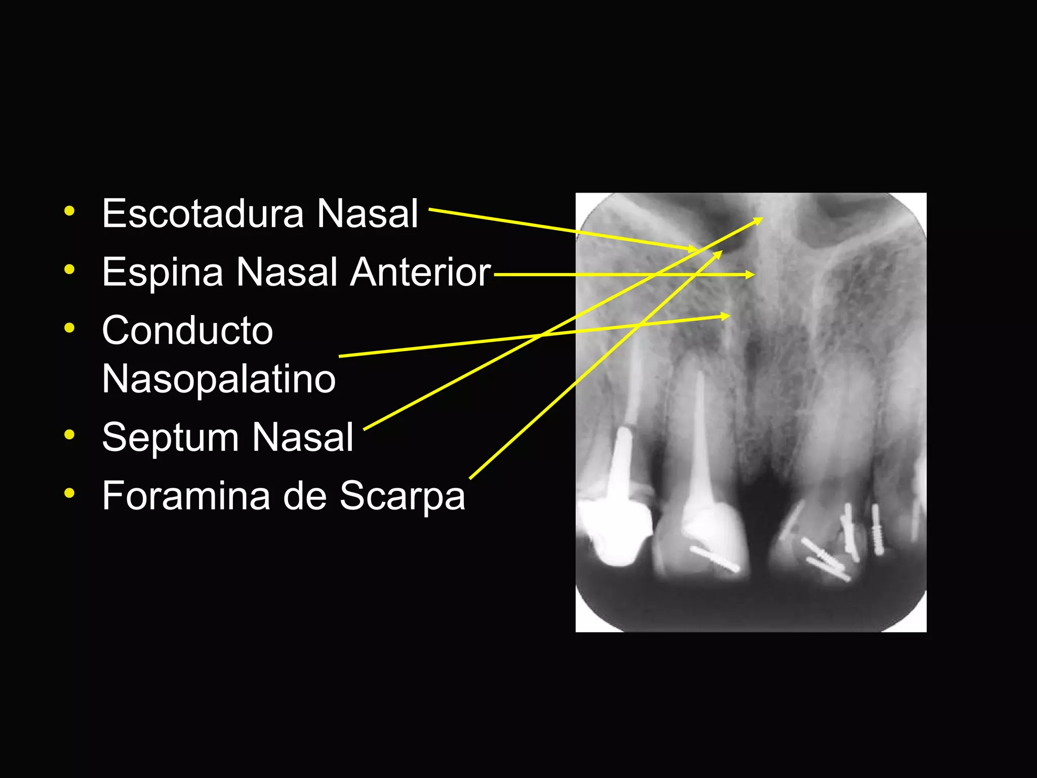 Anatomia radiográfica maxilar y mandíbula uss rx | PPT