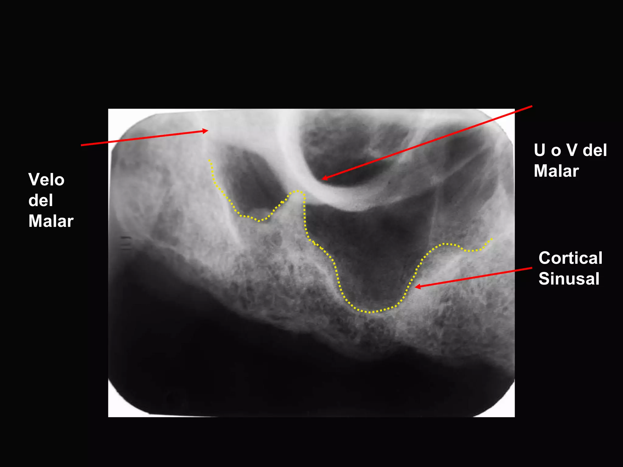 Anatomia radiográfica maxilar y mandíbula uss rx | PPT