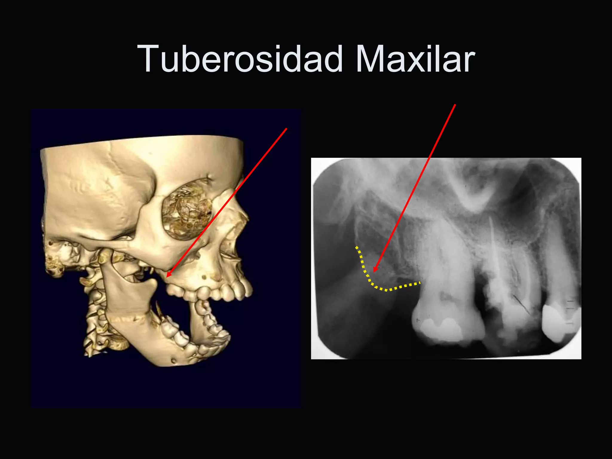 Anatomia radiográfica maxilar y mandíbula uss rx | PPT