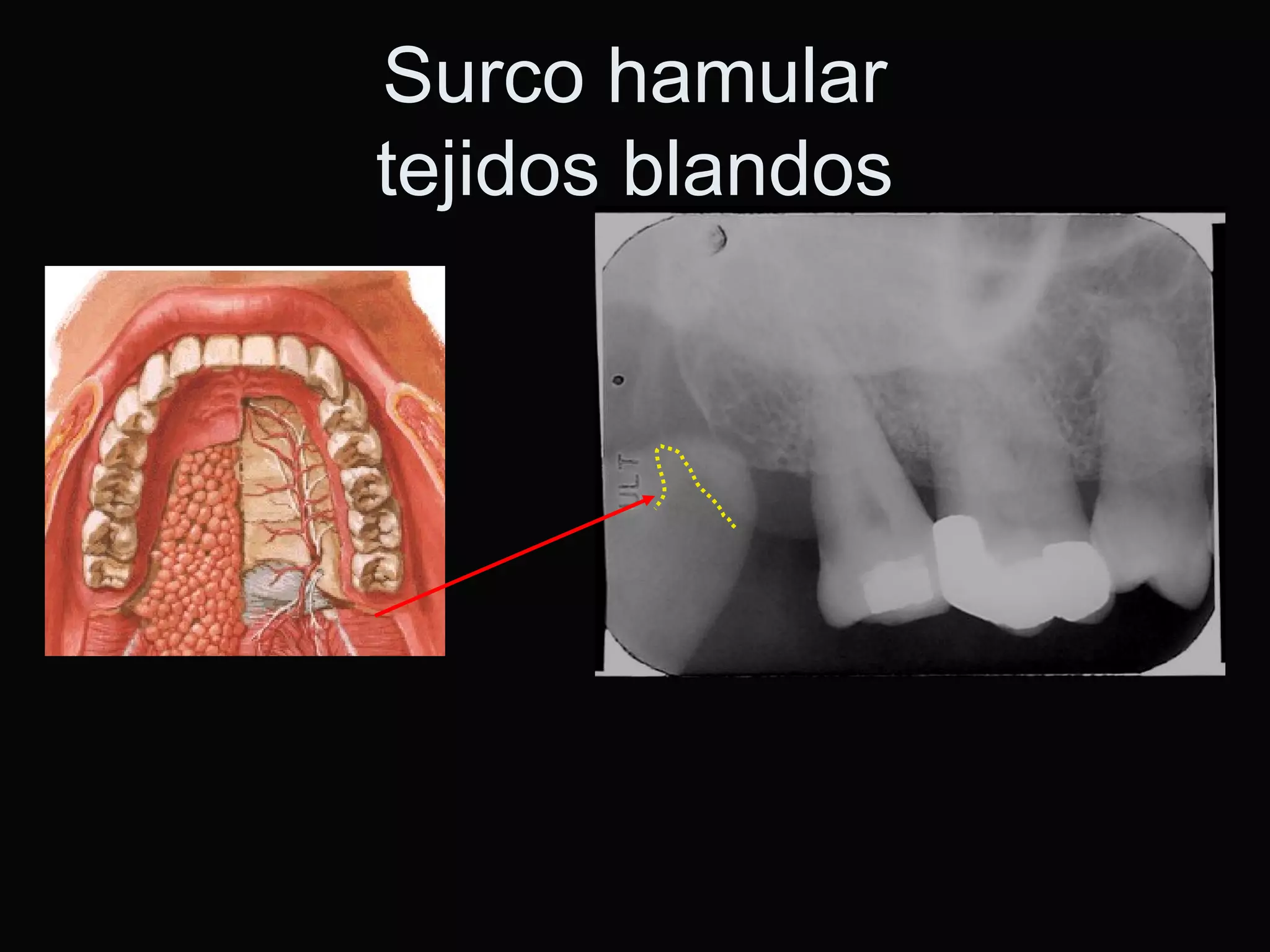 Anatomia radiográfica maxilar y mandíbula uss rx | PPT