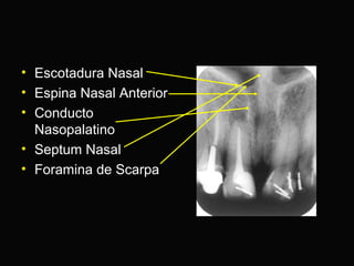 Anatomia radiográfica maxilar y mandíbula uss rx | PPT