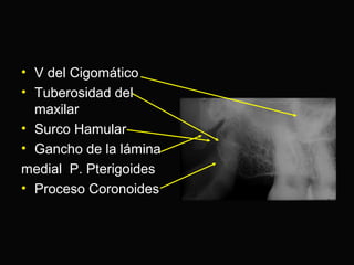 Anatomia radiográfica maxilar y mandíbula uss rx | PPT