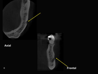 Anatomia radiográfica maxilar y mandíbula uss rx | PPT