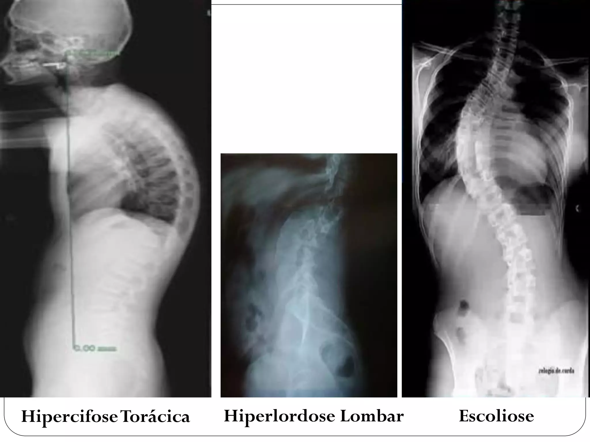 Anatomia radiológica da coluna vertebral | PDF