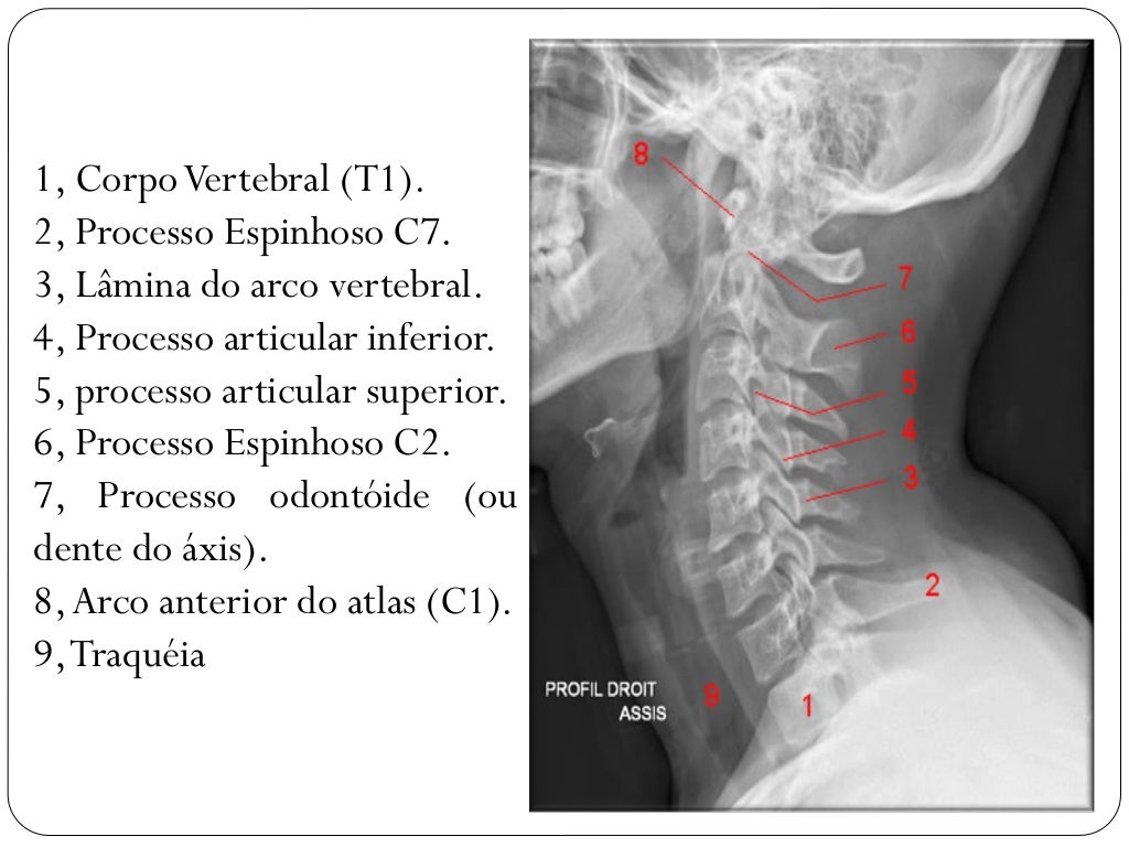 Anatomia radiológica da coluna vertebral