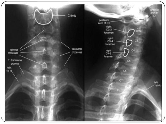 Anatomia radiológica da coluna vertebral