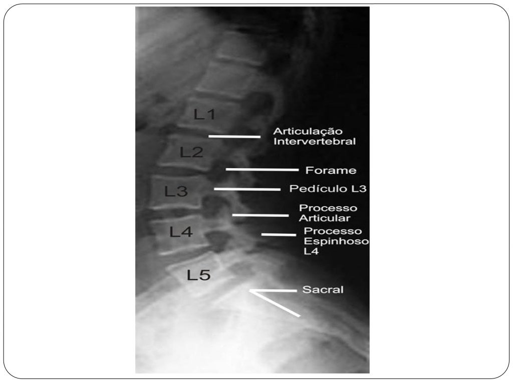 Anatomia radiológica da coluna vertebral