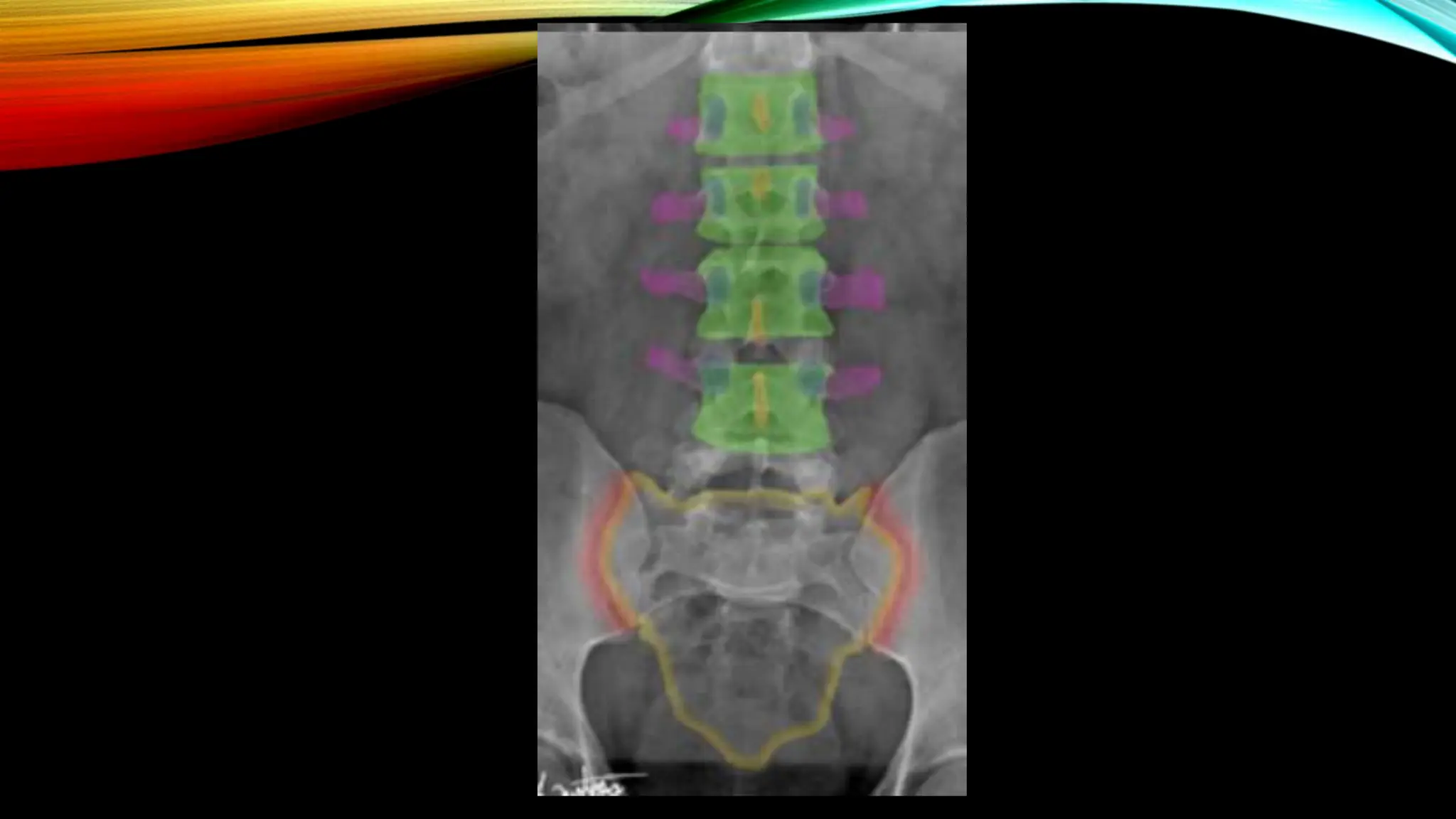 ANATOMIA RADIOLOGICA DA COLUNA CERVICAL, TORACICA E LOMBAR | PPTX