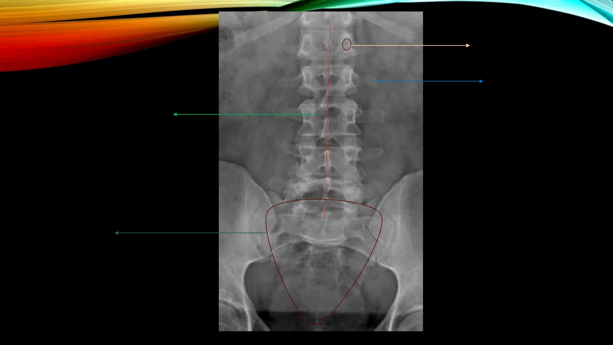 ANATOMIA RADIOLOGICA DA COLUNA CERVICAL, TORACICA E LOMBAR | PPTX
