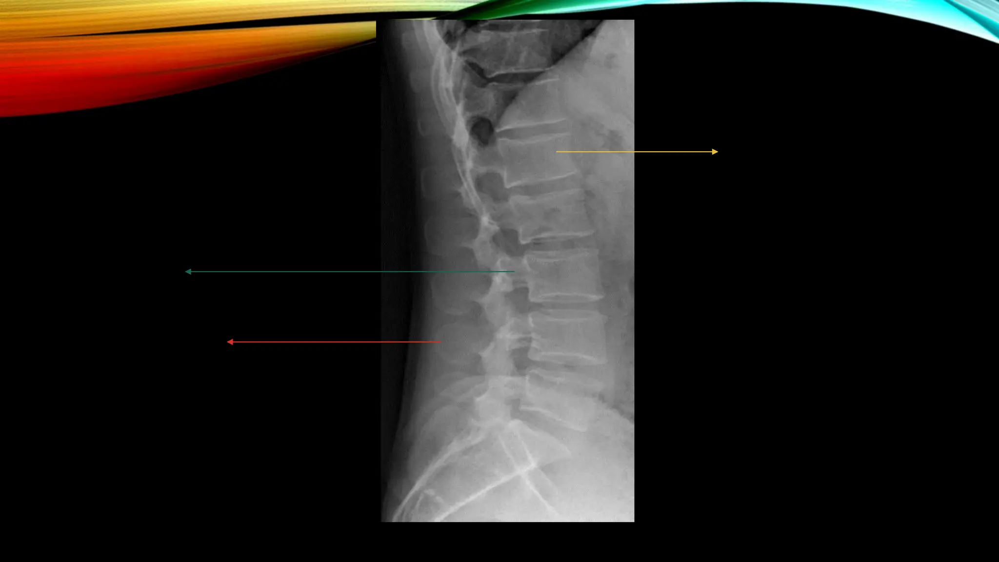 ANATOMIA RADIOLOGICA DA COLUNA CERVICAL, TORACICA E LOMBAR | PPTX
