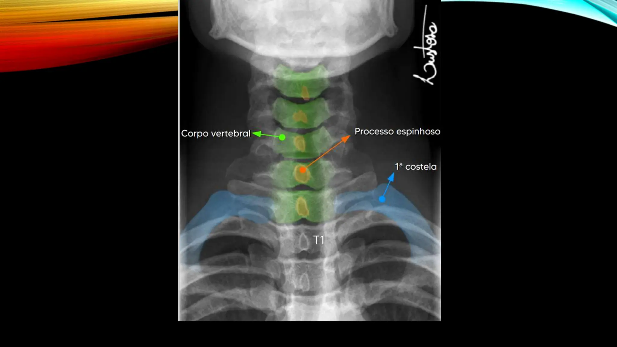 ANATOMIA RADIOLOGICA DA COLUNA CERVICAL, TORACICA E LOMBAR | PPTX