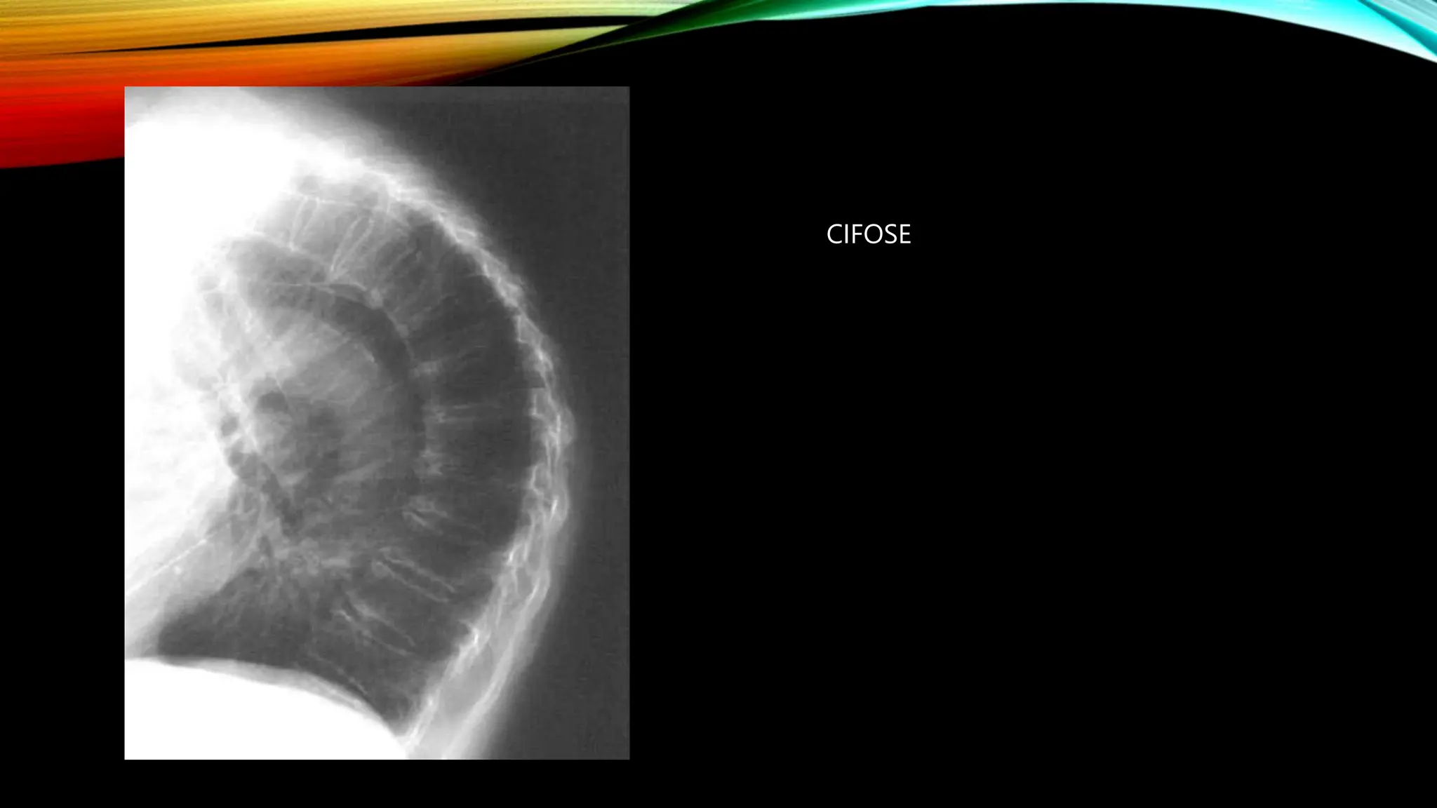 ANATOMIA RADIOLOGICA DA COLUNA CERVICAL, TORACICA E LOMBAR | PPTX