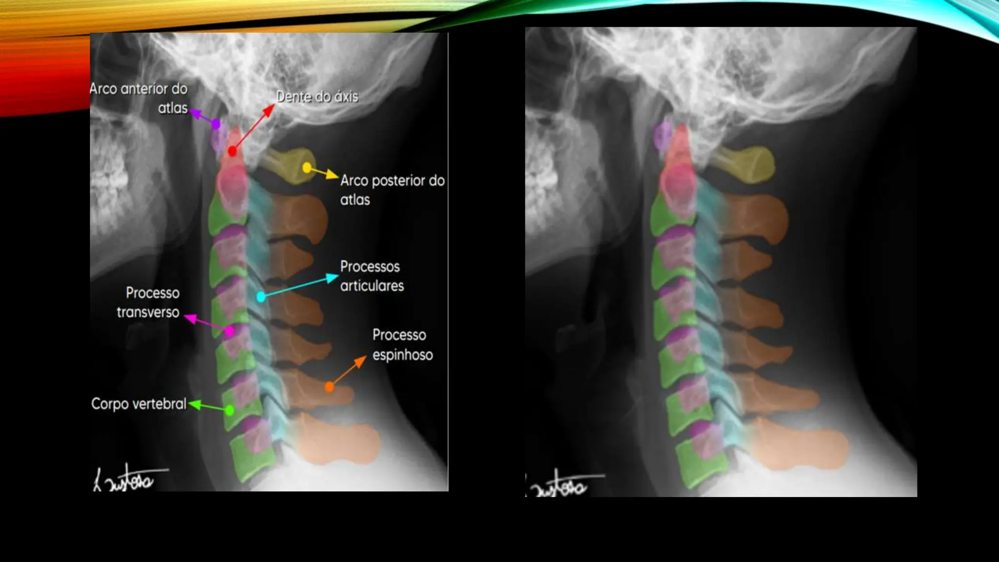 ANATOMIA RADIOLOGICA DA COLUNA CERVICAL, TORACICA E LOMBAR | PPTX