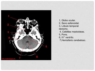 Anatomia radiologica del cerebro | PPTX