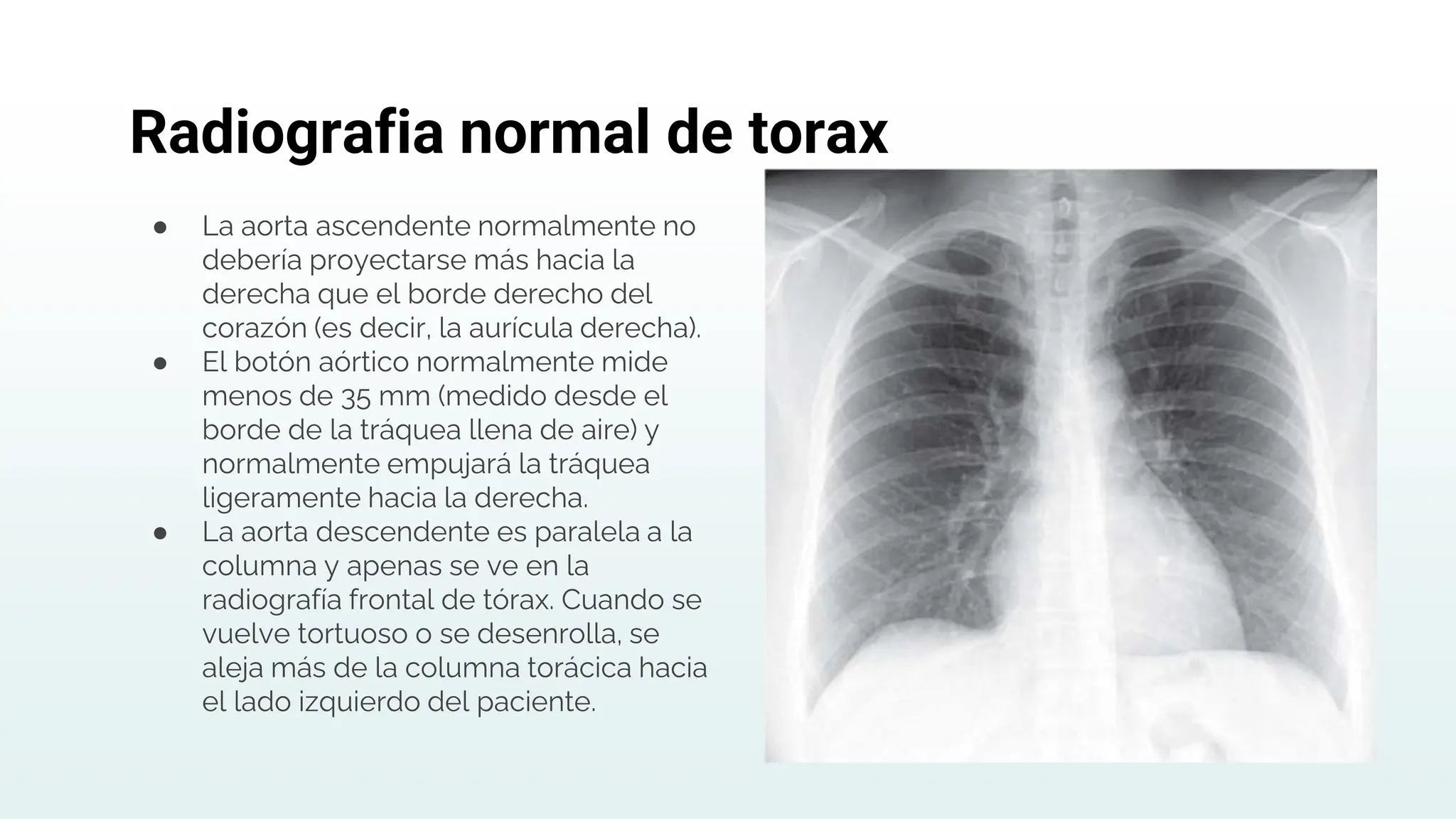 estudio de anatomia radiologica del Torax.pptx