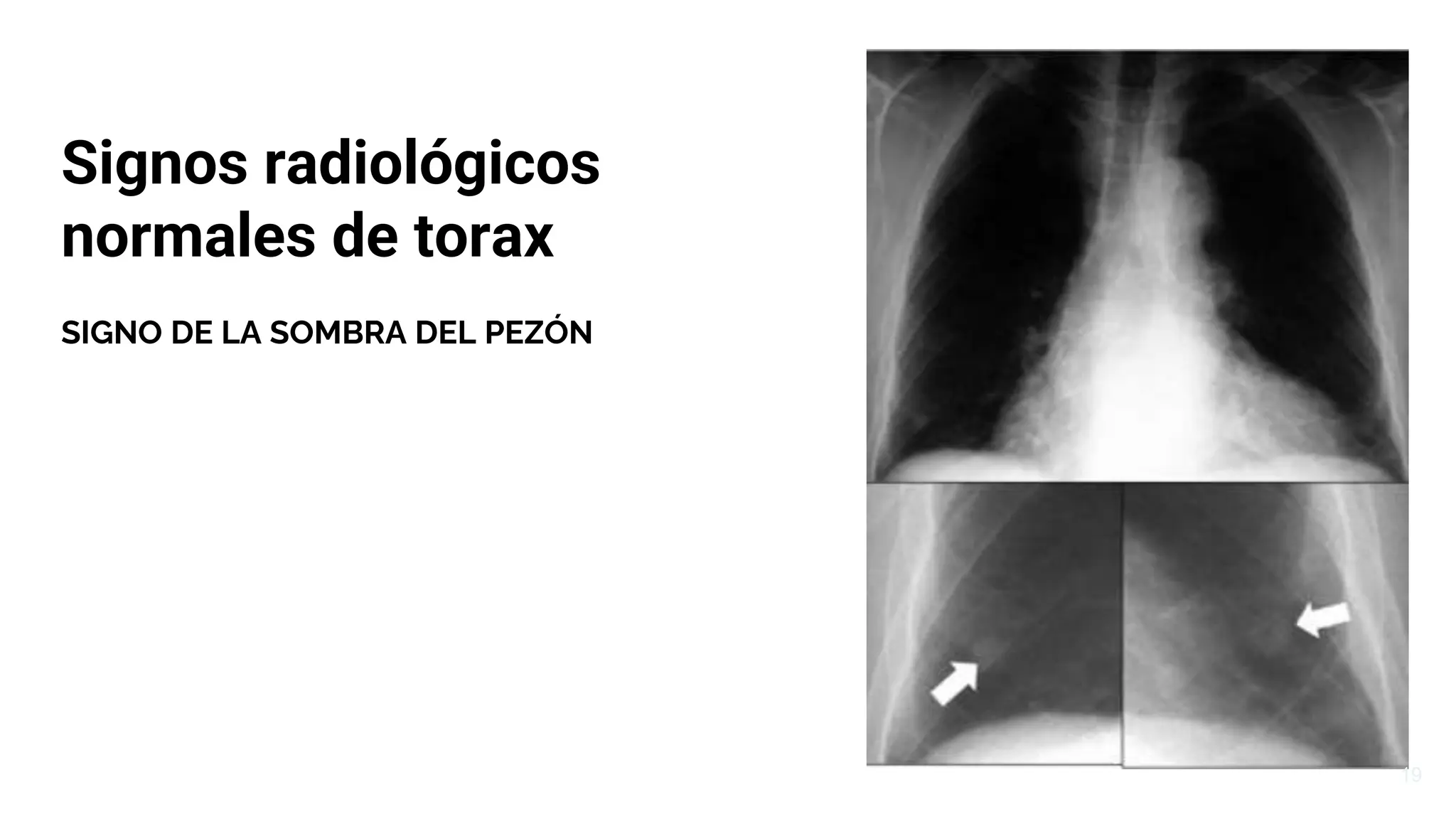 estudio de anatomia radiologica del Torax.pptx