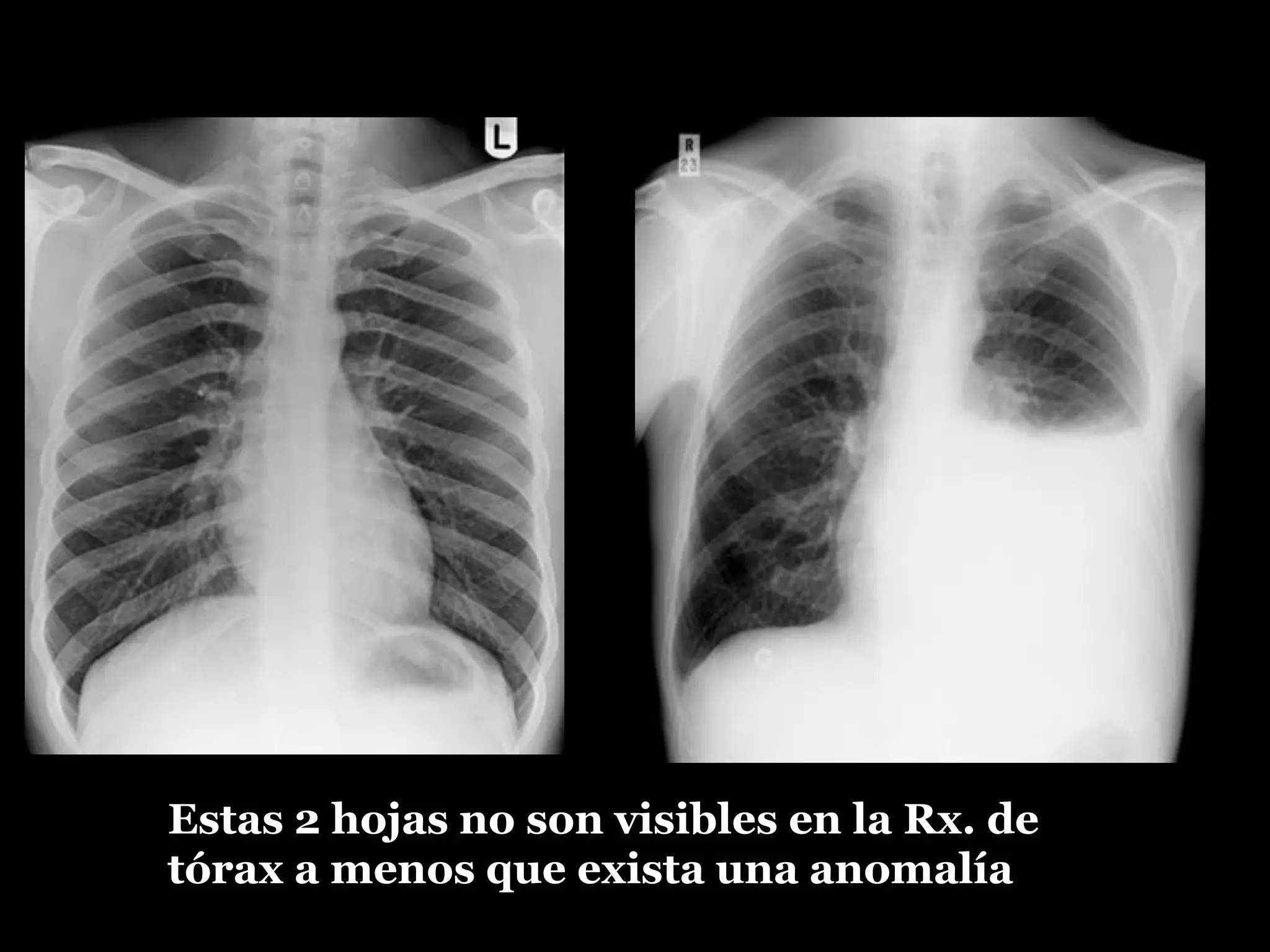 ANATOMIA RADIOLOGICA DEL TÓRAX. TOMOGRAFIAS AREA | PDF