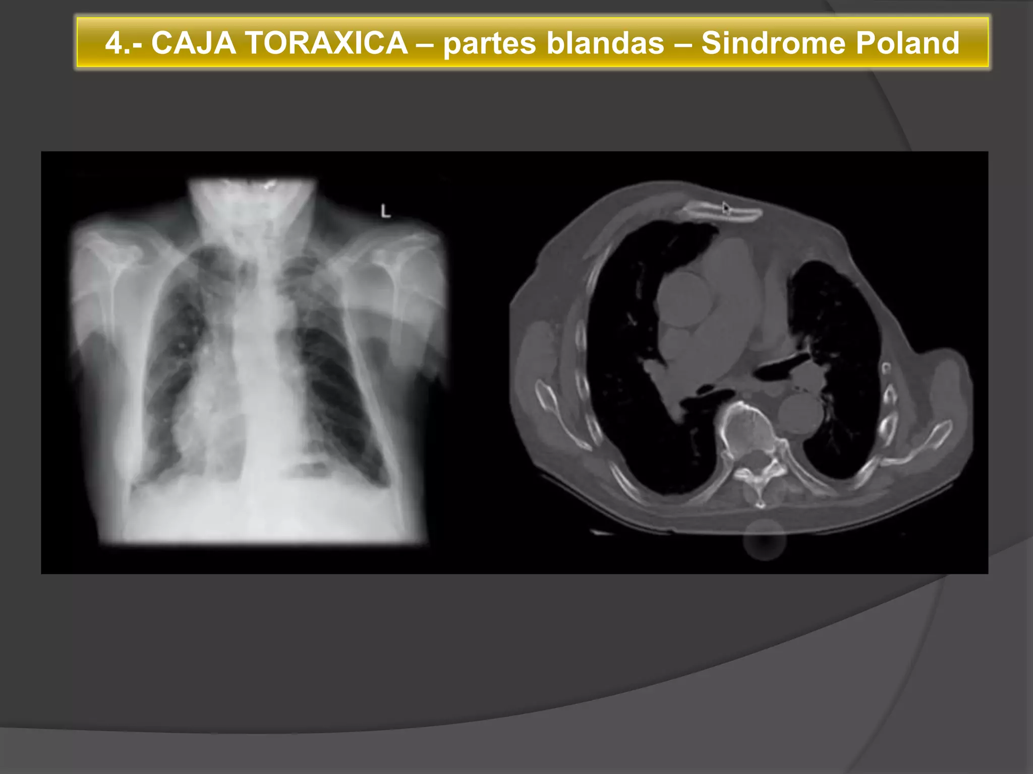 ANATOMIA RADIOLOGICA DEL TORAX 1.pptx