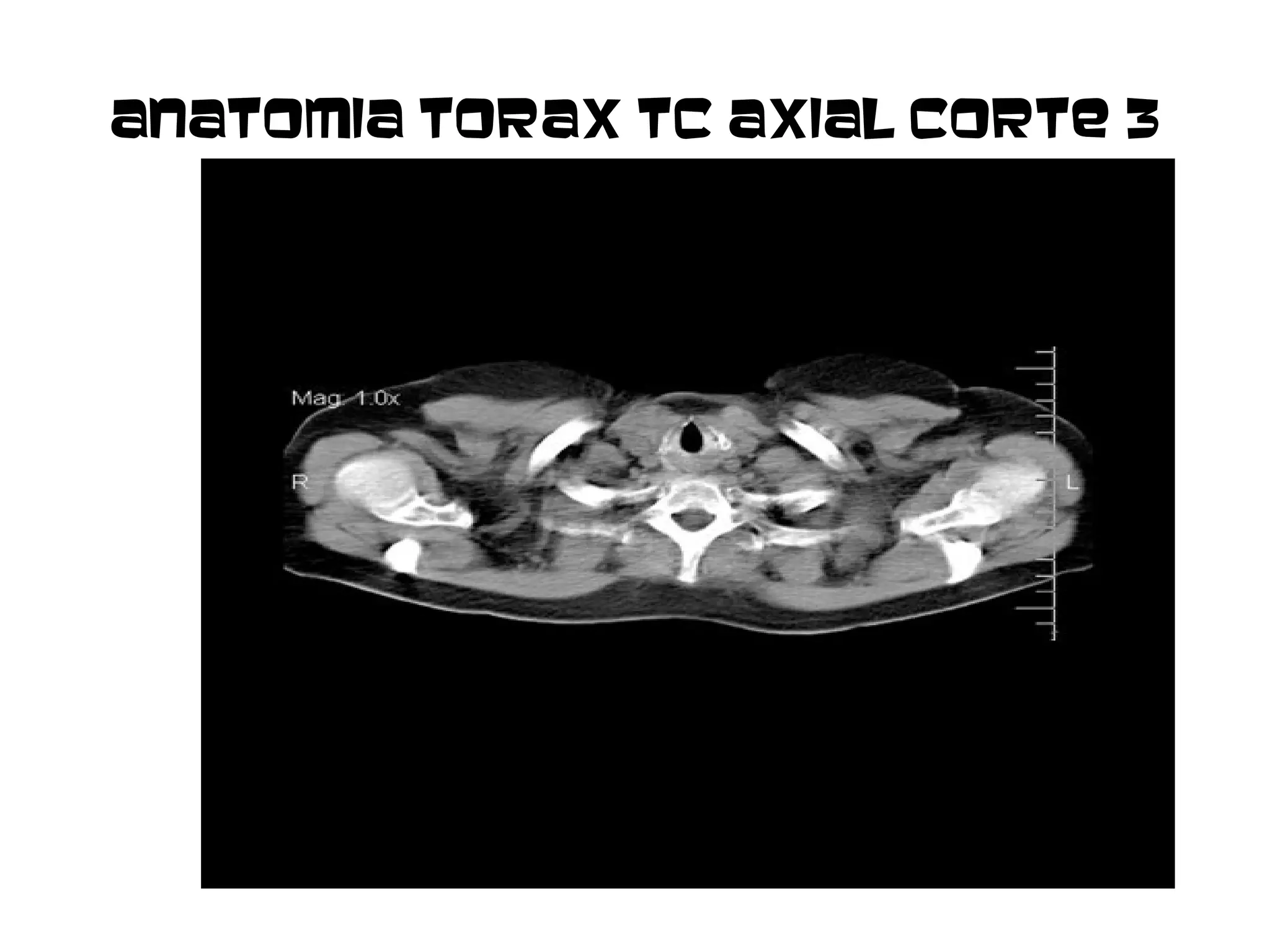 Anatomia radiologica de_torax_parte_2 | PPT