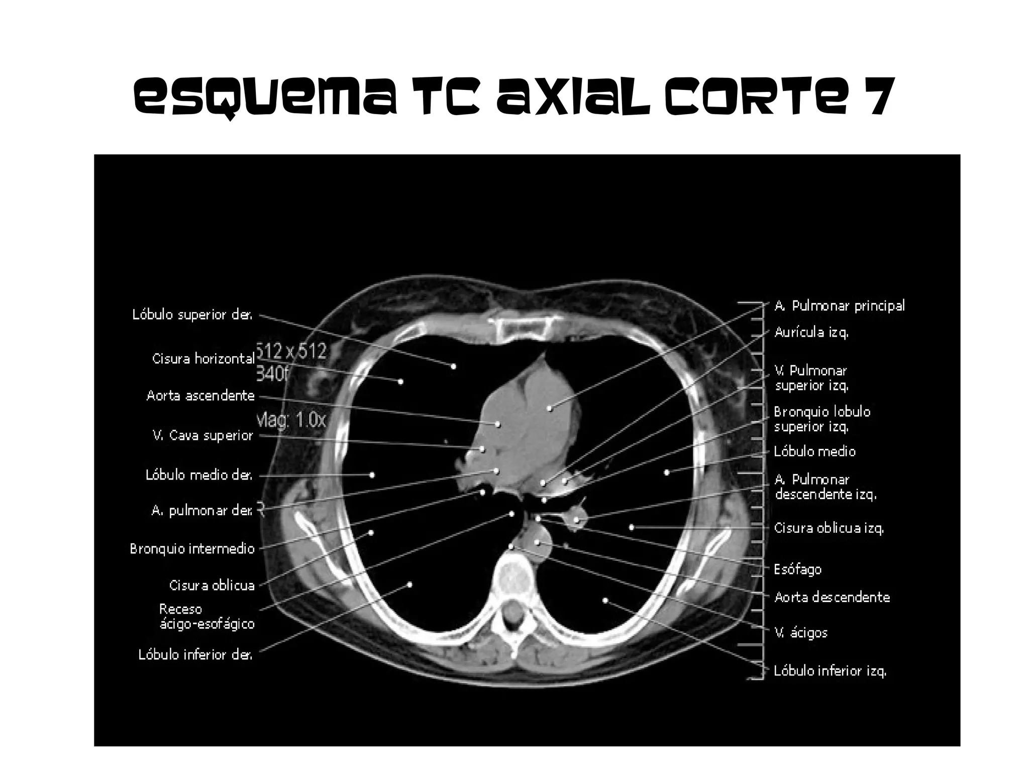 Anatomia radiologica de_torax_parte_2 | PPT