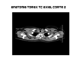 Anatomia radiologica de_torax_parte_2 | PPT